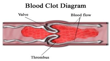Blood clots: what they are and how they become problems | Minnesota ...